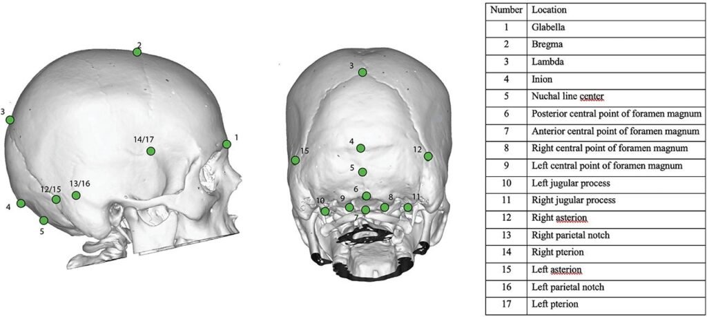 Neanderthal genes linked to rare brain-skull disorder, study finds ...
